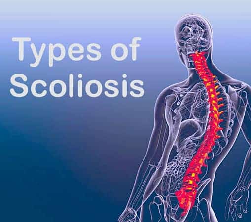 Types of Scoliosis - Custom Chiropractor