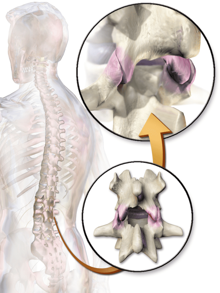 Rotational Sport Injuries - Custom Chiropractor